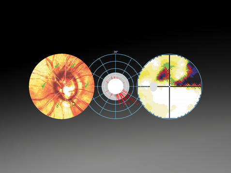 Octopus 600 - EyeSuite glaucoma analysis